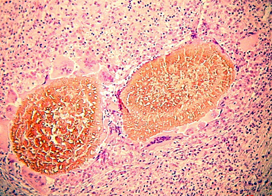 EL RINCÓN DE LA MEDICINA INTERNA. juanpedromacaluso@yahoo.com.ar: MICETOMA