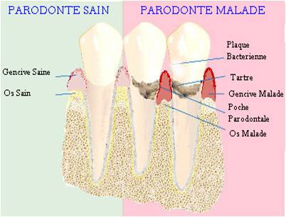Aphte | Tout sur : prévention, soins, remèdes naturels & traitements ...