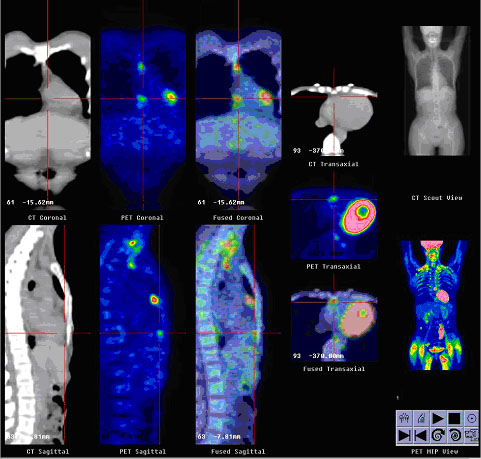 MedicineNet : Lung Cancer