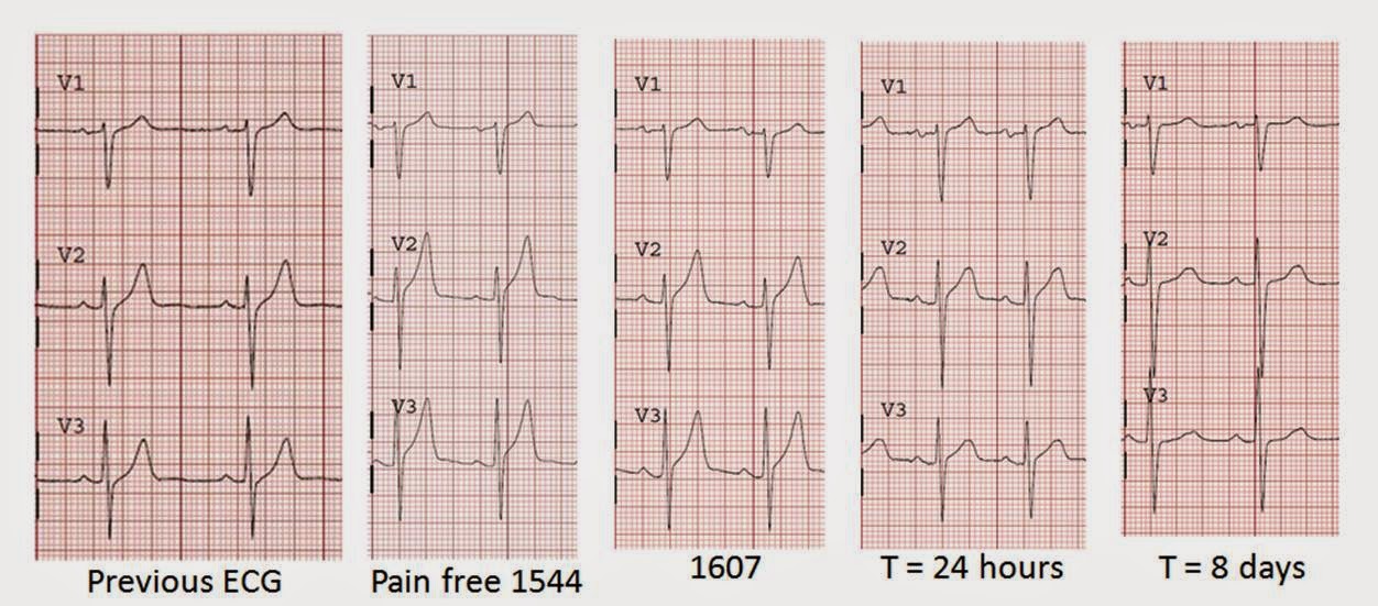 Serial Ecg Frequency - lsaangels