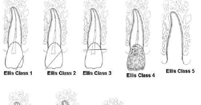 Tooth Fracture Classification
