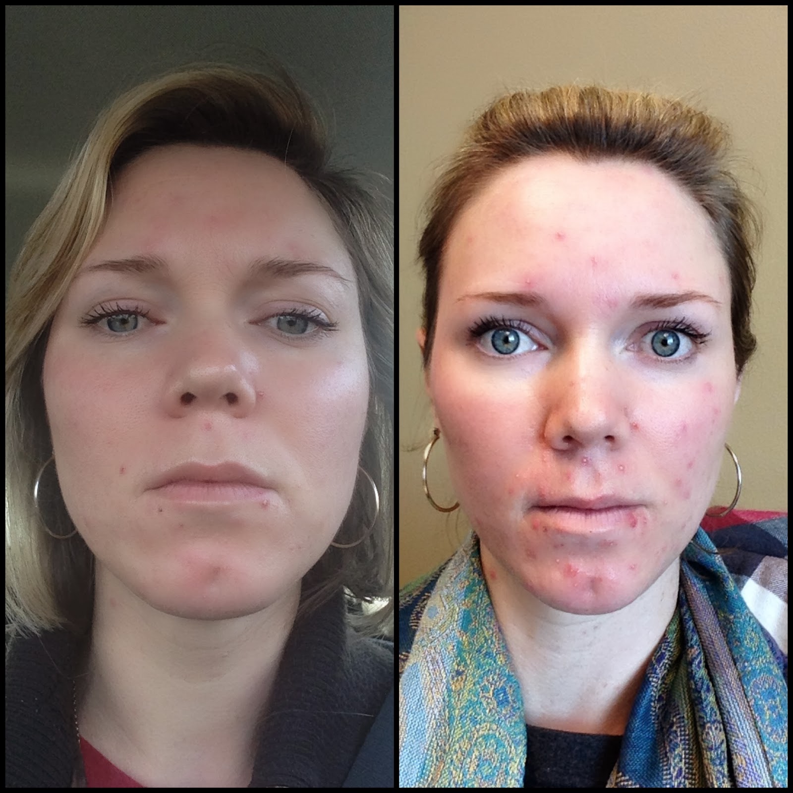 Happy 30th ~ Love, Cancer: Chemo Reality