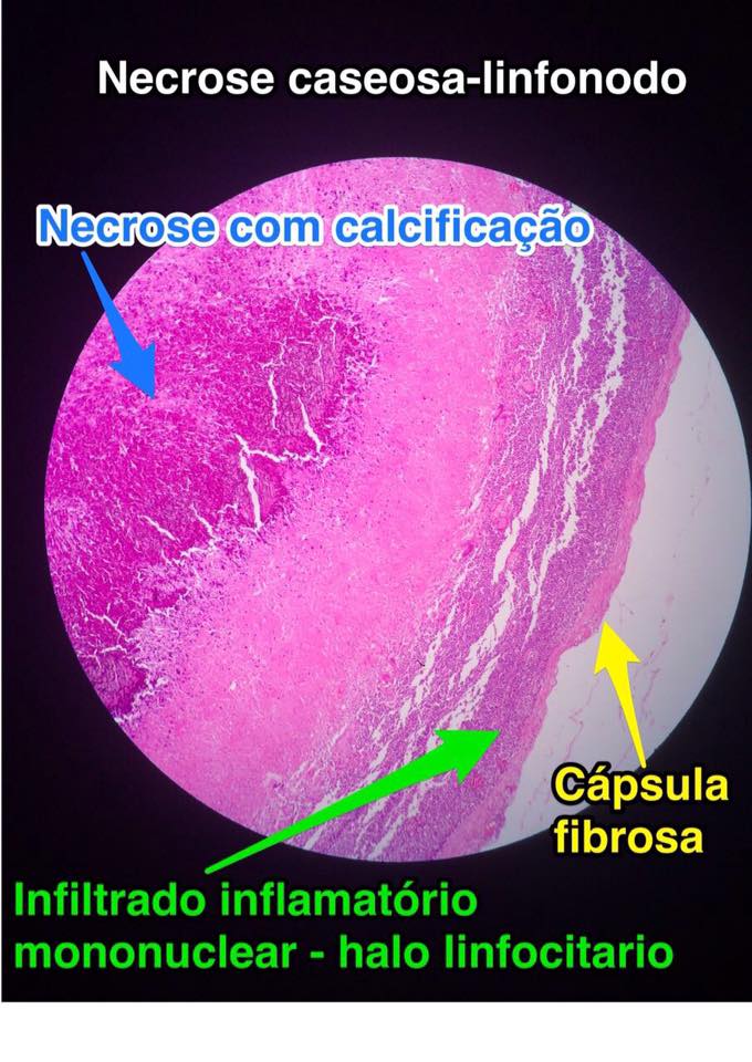 HISTOLOGIA90: TIPOS DE NECROSE