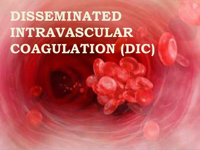 Koagulasi Intravaskular Terdiseminasi