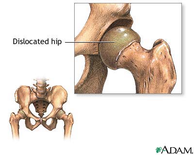 Free For Health: Congenital Hip Dislocation - Symptoms and How It Is ...