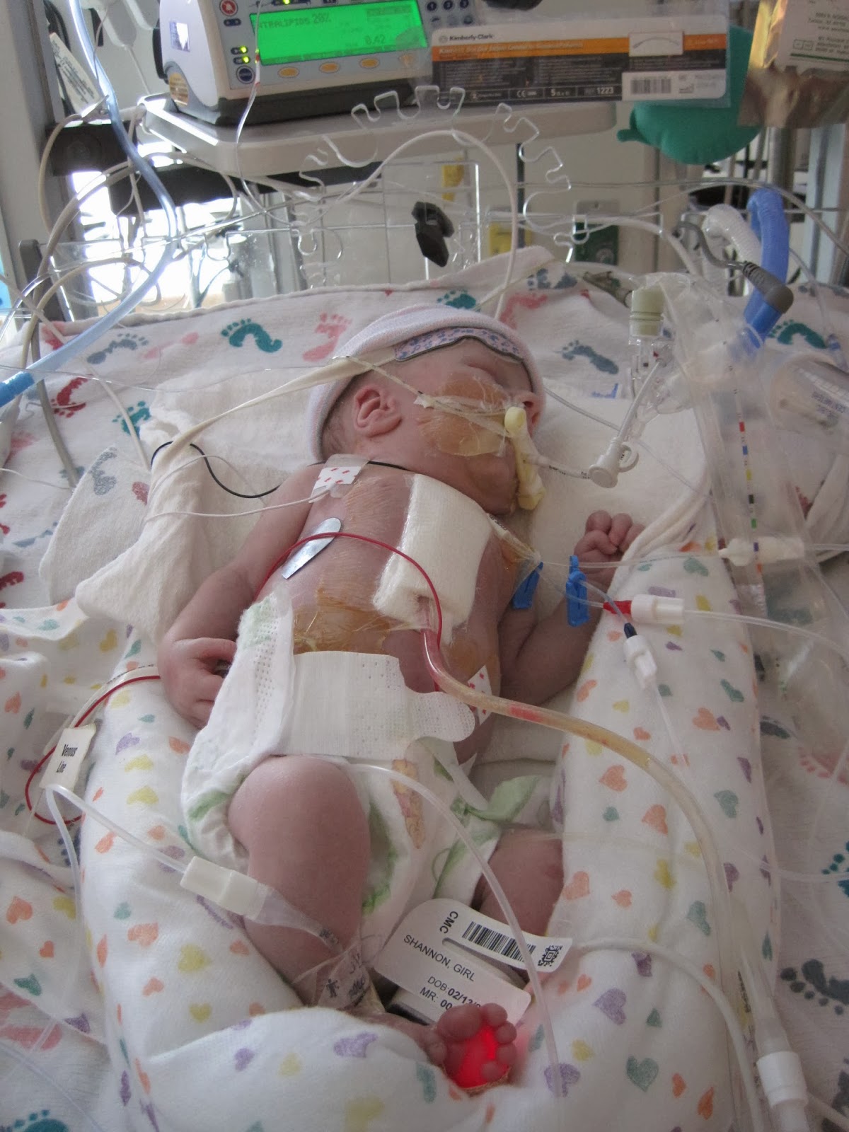 journey of a heart baby: Surgery Day and recovery