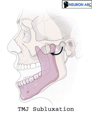 hiphoplife: tmj subluxation