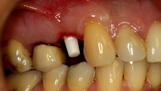 Silver Teeth Implants - Silver Choices