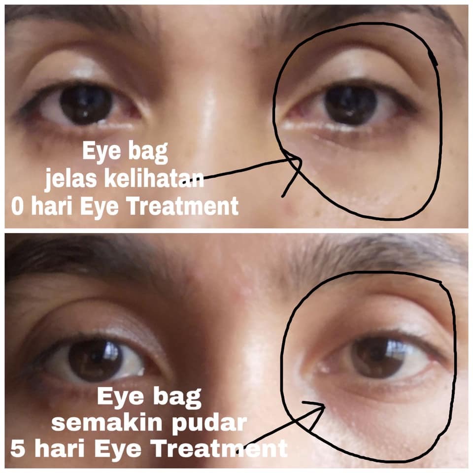 Cara Cepat Hilangkan Mata Sembap, Hanya 5 Hari | Hadiah Terindah, Dari ...