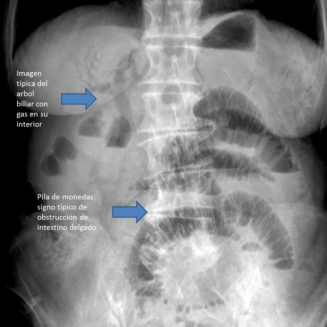 Soluciones Quirúrgicas: Ileo biliar