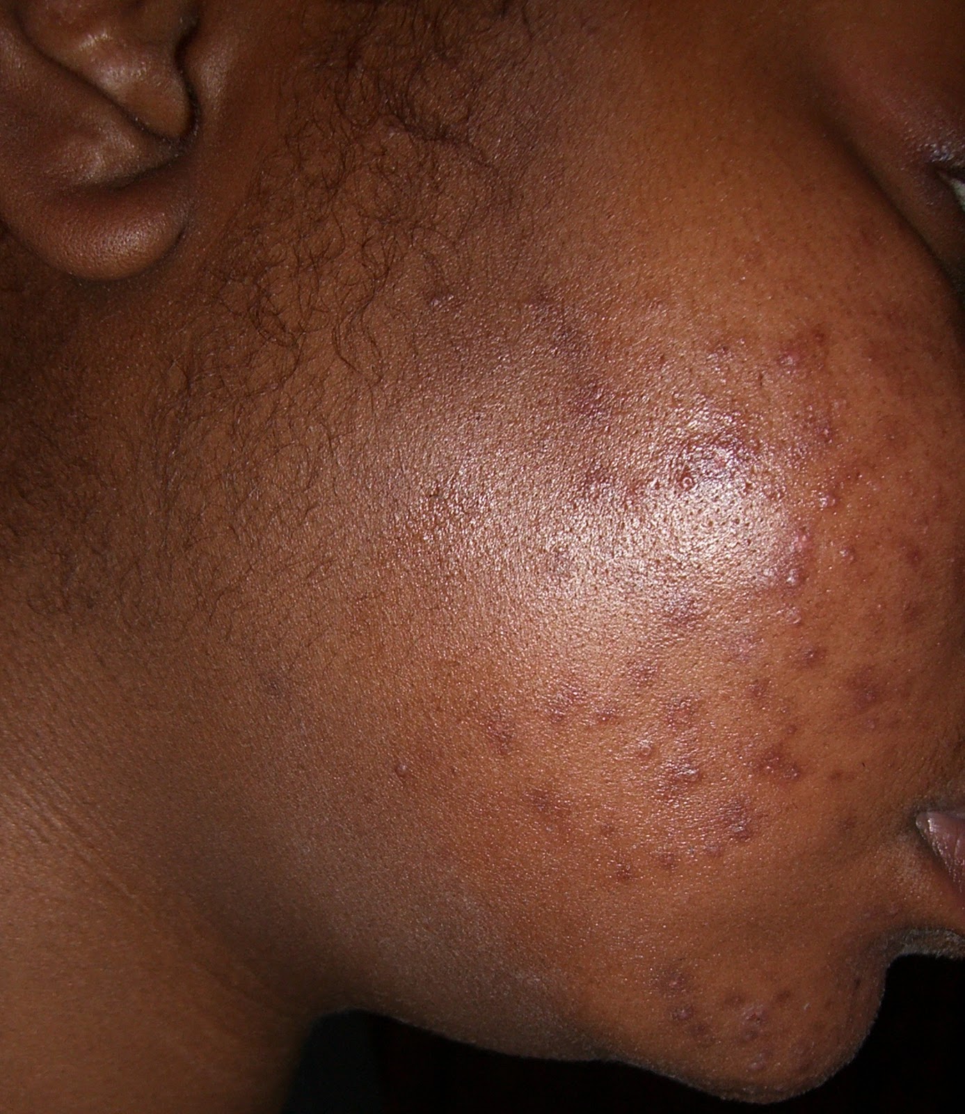 Top 105+ Pictures Images Of Boils On Skin Full HD, 2k, 4k