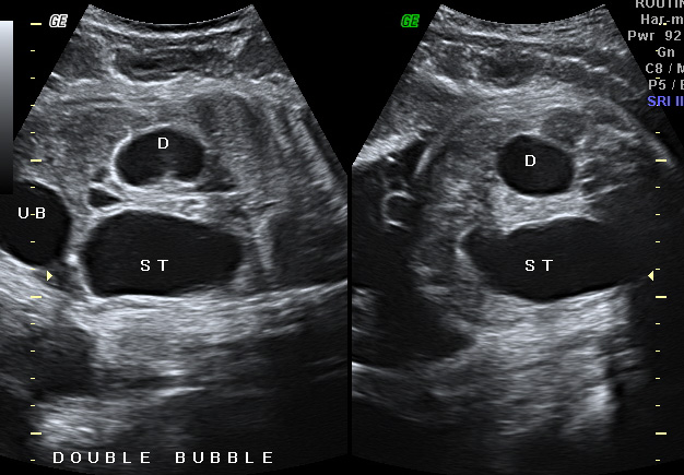 Double Bubble Sign - Sumer's Radiology Blog