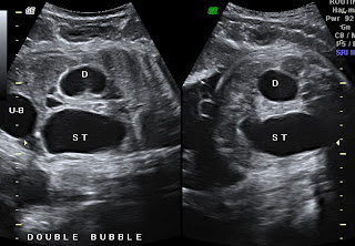 Double Bubble Sign - Sumer's Radiology Blog