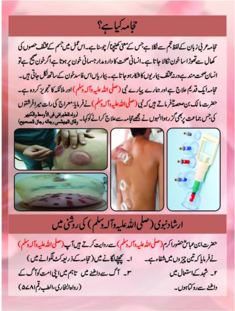 HIJAMA ( Blood Cupping ): Hijama Disease Points