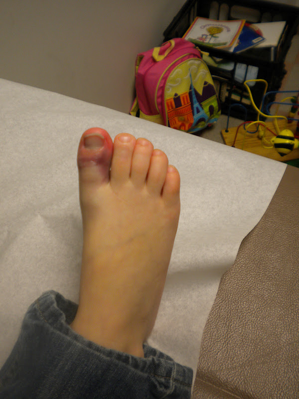 Our Dream x3: Luke Broke his BIG Toe