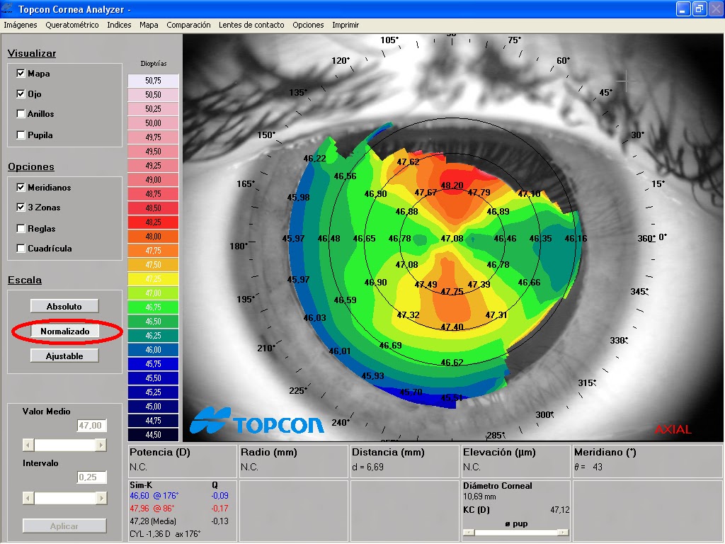 Topografia De Córnea Pelo Sus - RETOEDU