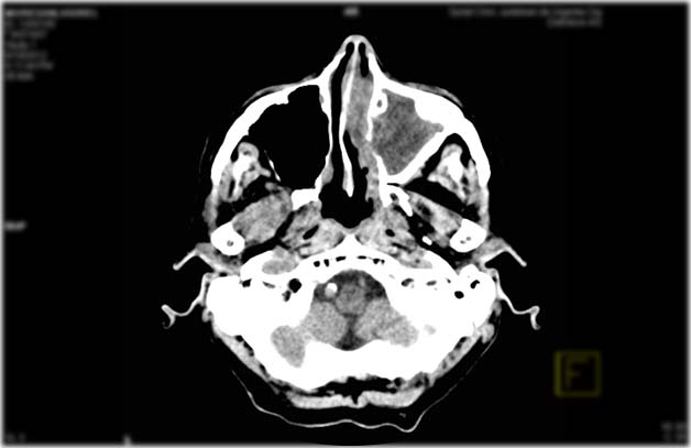 Pansinusitis on the left side - CT Scan