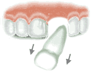 Clínica Dental Hnos. Domínguez Aramendi: ¡Socorro! Se me ha caído un ...