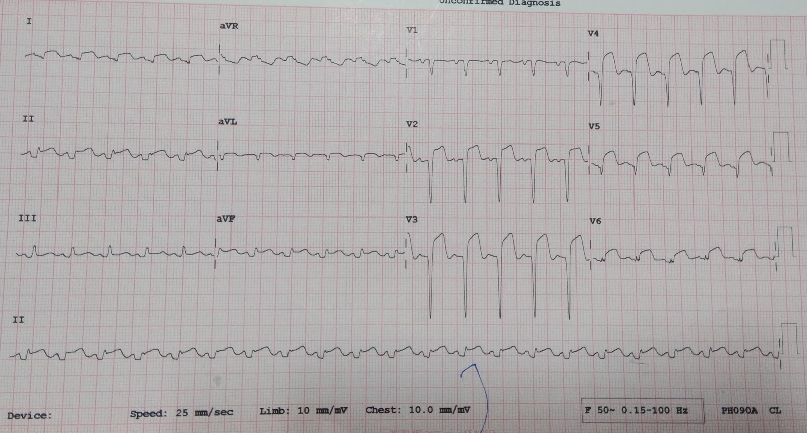 Cardiology window: Ventricular flutter in a patient with anterior wall ...