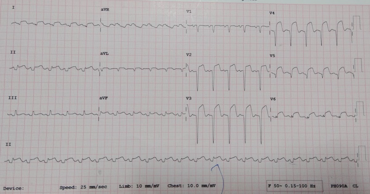 Cardiology window: Ventricular flutter in a patient with anterior wall ...
