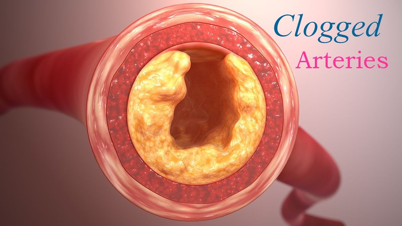 MEDICAL MIRACLES : 20 Remedies To Avoid Clogged Arteries
