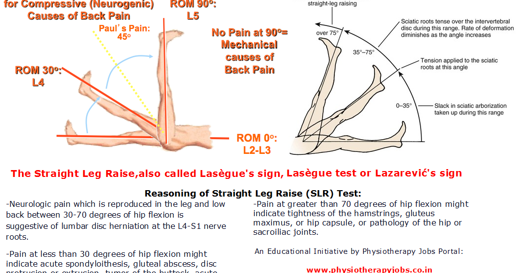 Physiotherapy JOBS: The Straight Leg Raise (SLR) Test