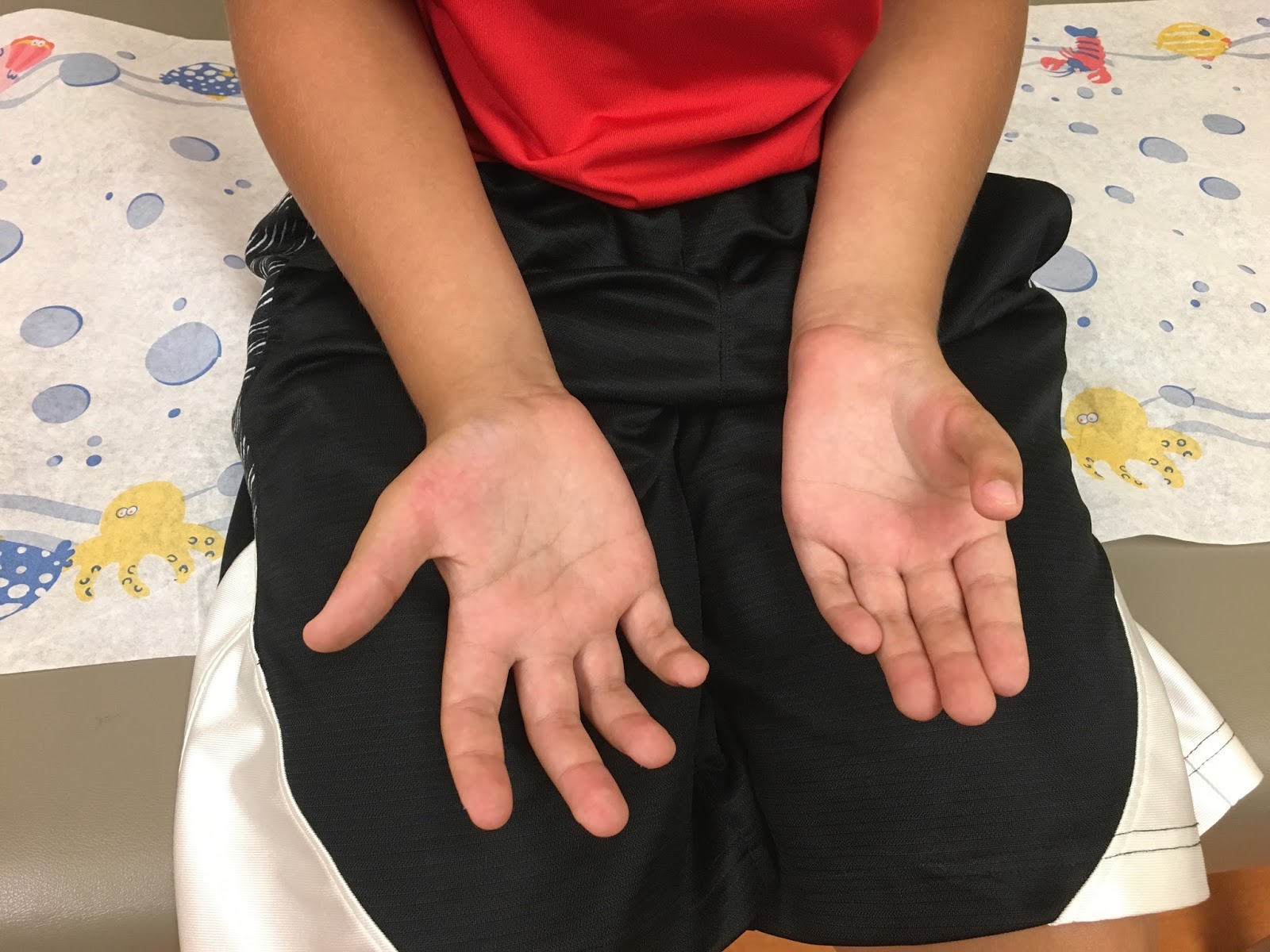 Stiff Fingers Congenital Hand And Arm Differences