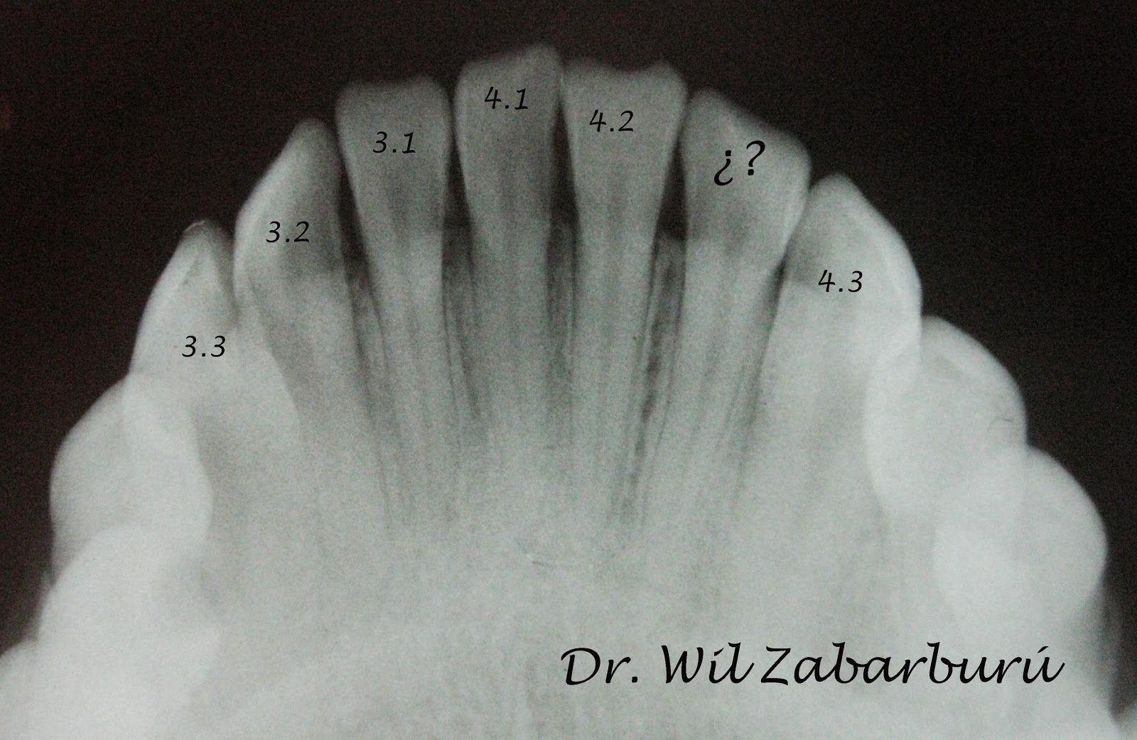 CLINICA DENTAL ASISTENCIAL: DIENTES SUPLEMENTARIOS, INCISIVO LATERAL