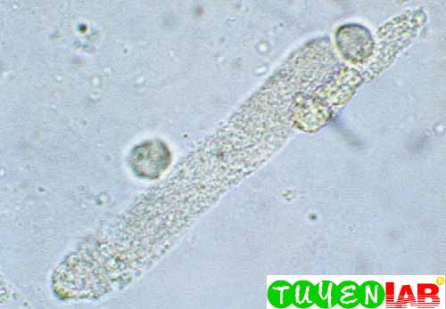 Atlas of Casts in urine | Free Medical Atlas