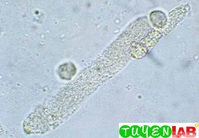 Atlas of Casts in urine | Free Medical Atlas