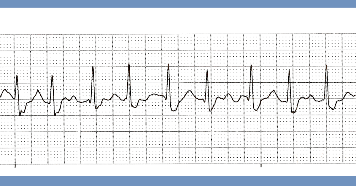 Float Nurse: EKG Practice Strips 321