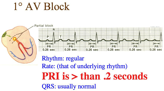 First Degree AV Block | INA - ECG