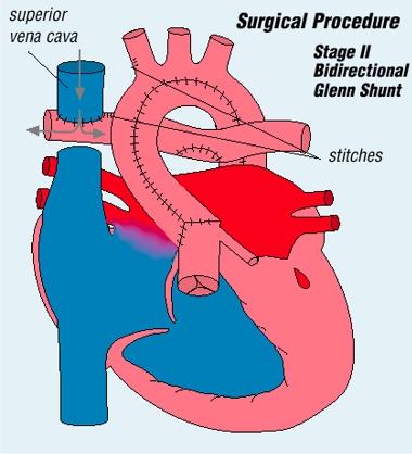 LIFE with HLHS ( hypo-plastic left heart syndrome ): 2013