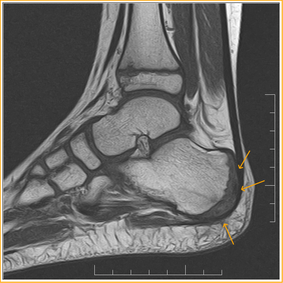 Calcaneal Apophysitis: Sever's Disease - Sumer's Radiology Blog