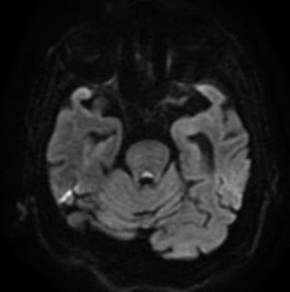 Dr Balaji Anvekar's Neuroradiology Cases