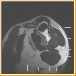 Spinoglenoid Notch Ganglion Cyst-MRI - Radiology Imaging