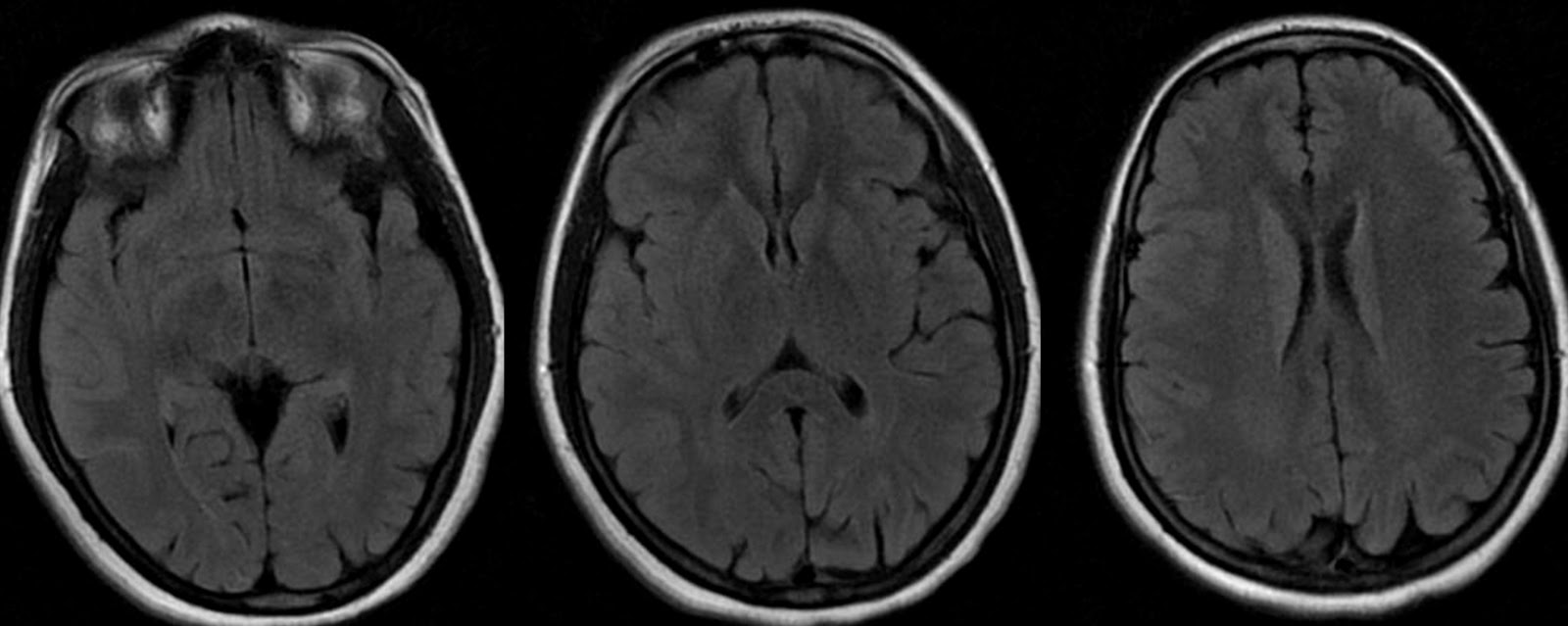 Dr Balaji Anvekar FRCR: Imaging in Acute Ischemic Stroke