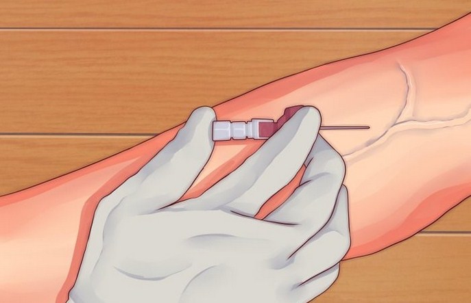 cara pasang infus yang benar dan tepat | Perawat-id