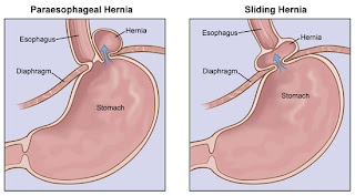 Hiatus Hernia: Types of Hiatus Hernia Therapy