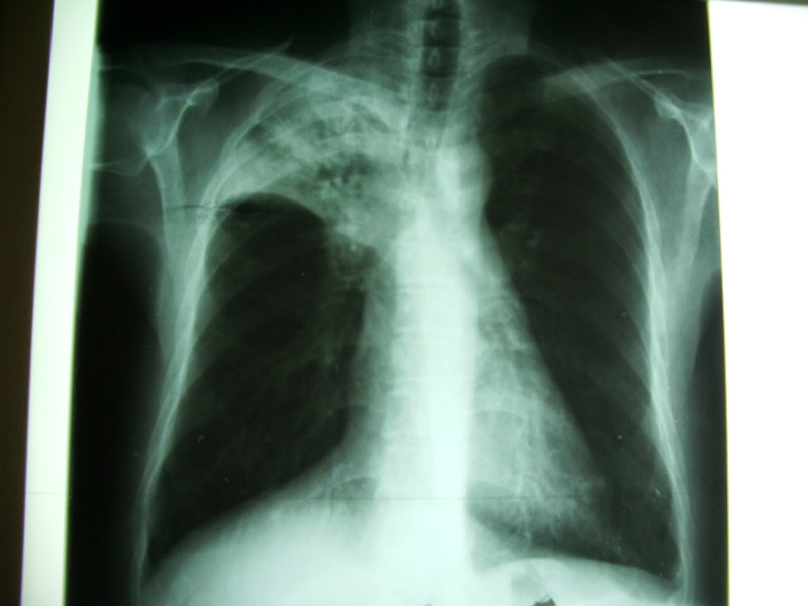 Telethorax