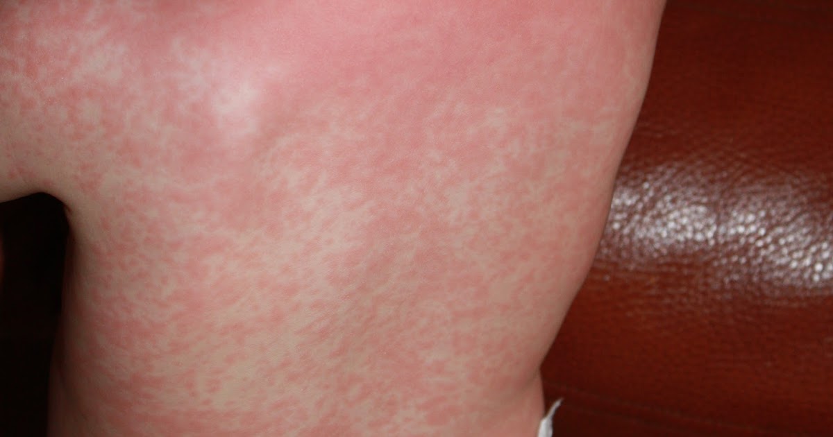 Daily Blog: Diagnosis: Roseola