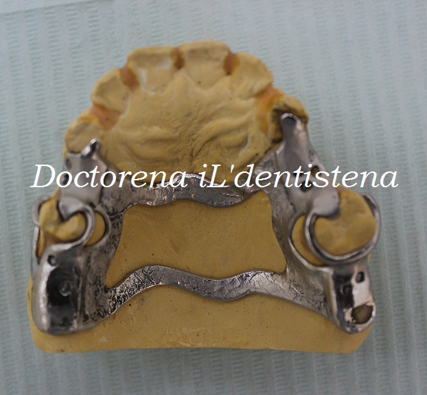 My Dental Diary: CO-Cr. RPD