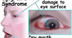 Sjogren's Syndrome, Cause, Types, Pathogenesis, Clinical Signs and ...