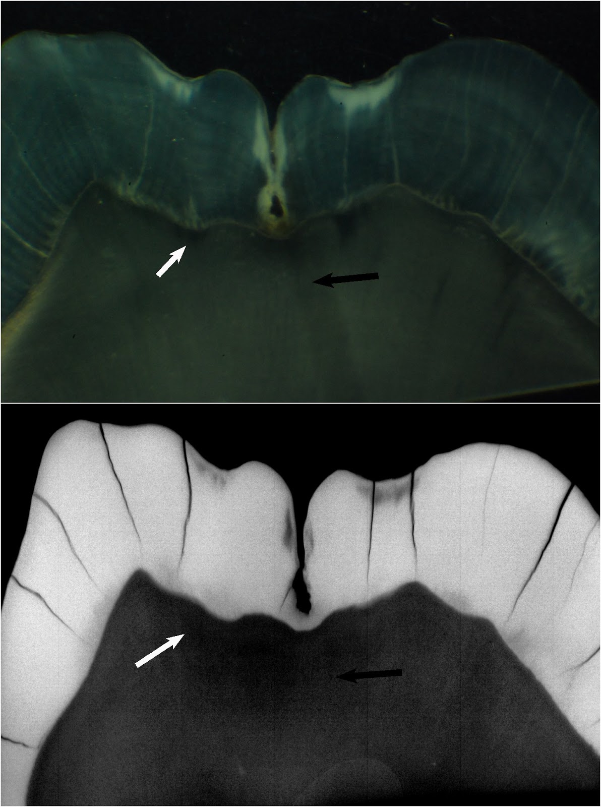 Polarizing microscopy of dental enamel and caries histopathology