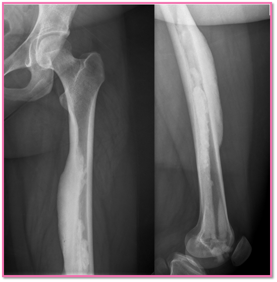 RADIOLOGY IMAGE SPOTTERS: Melorheostosis