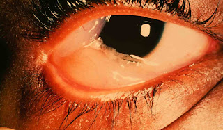 Photos For Chemosis ~ YOUNG DOCTORS' RESEARCH FORUM