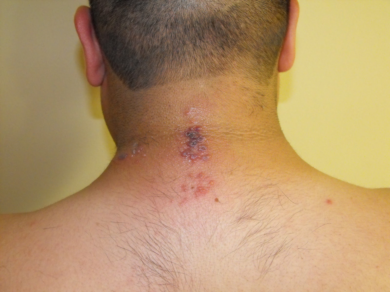 La Dermatosis de la Semana: Herpes Zoster