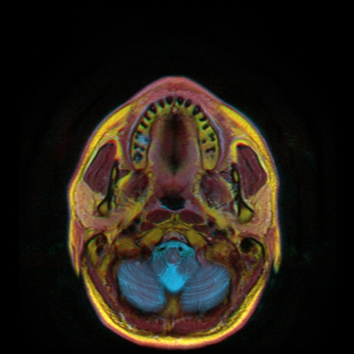 Nevit's blog: Color MRI of the Neck