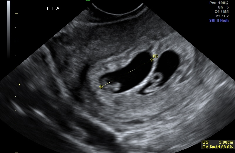 + 1 (make that 2) will make us a family: 8 Weeks Pregnant today