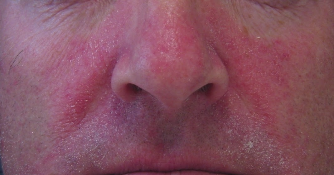 Skin Temple: Not every red facial rash is Rosacea!